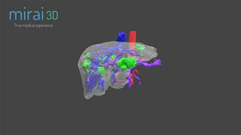 3d Model For Hepatectomy Surgical Planning 3d Model By Mirai3d 7bd1e4d Sketchfab