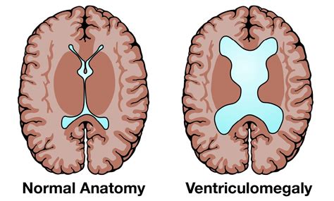 Enlarged Ventricles Brain Mri Asymmetry Of The Lateral Ventricles