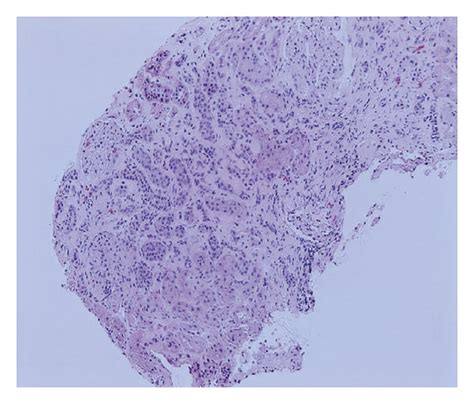 A Mild Focal Mesangial Hypercellularity Lobular Architecture And Download Scientific