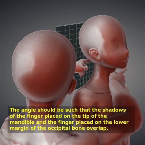 Cervical Spine Ap View｜tools For Radtech