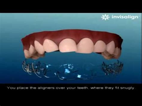 How Does Invisalign Work YouTube