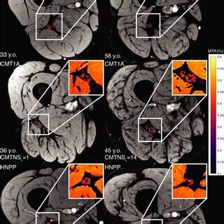 Representative Anatomical Images Of Study Subjects With Sciatic Nerve Download Scientific