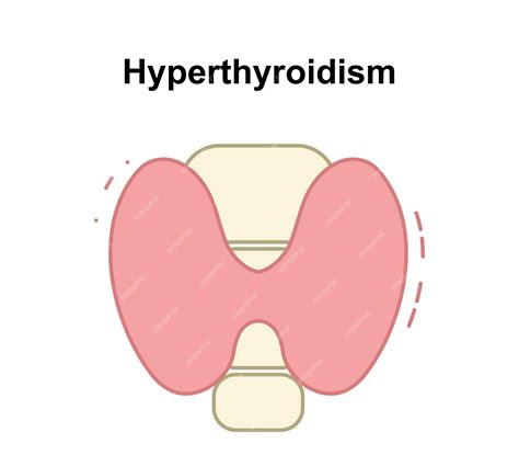 Premium Vector Hyperthyroidism Human Organ Flat Illustration
