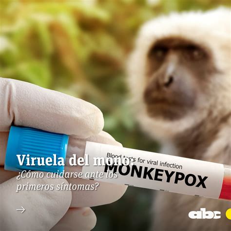 Abc Digital La Viruela Del Mono Es Una Enfermedad Que Se