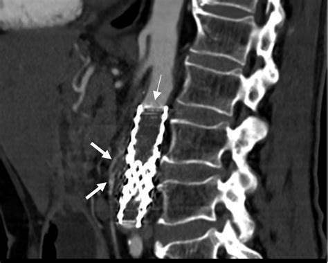 Iterative Algorithm For Metal Artefact Reduction Imar Mimicking Total Aortic Stent Graft