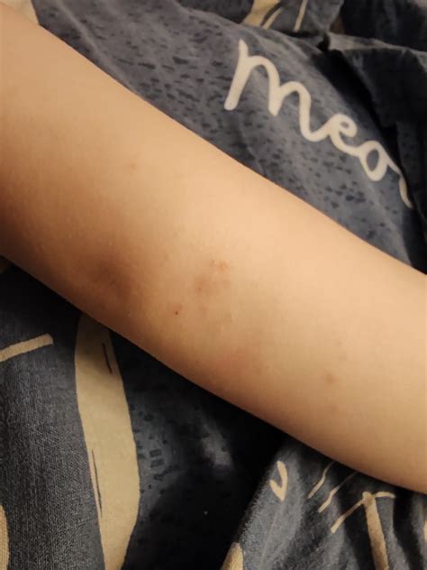 Сыпь у ребёнка 4 года Вопрос дерматологу 03 Онлайн