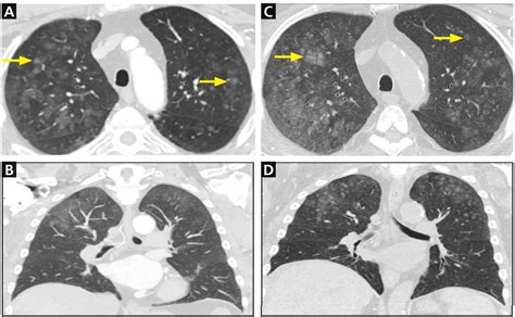 Metastatic Pulmonary Calcification And End Stage Renal Disease Cleveland Clinic Journal Of
