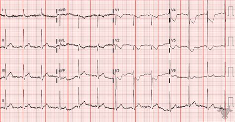Posterior Myocardial Infarction Ecg Stampede