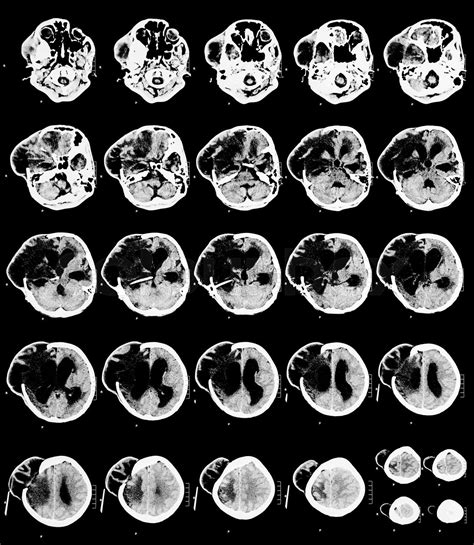Brain CT Scan Stock Image Colourbox