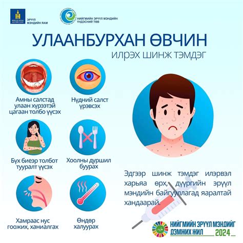 Өвөрхангай Танд улаанбурхан өвчний дараах шинж тэмдэг илэрвэл харьяа
