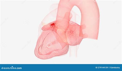 The Left Atrial Appendage Thrombus Stock Image 279144139