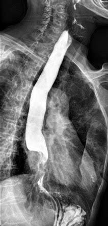 Distal Esophageal Cancer Radiology Case