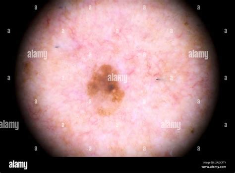 Dermatoscope Image Of A Seborrheic Keratosis On The Face Of A 68 Year