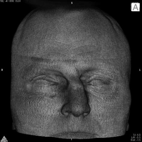 Three Dimensional Ct Reconstruction Of The Same Patient Demonstrating