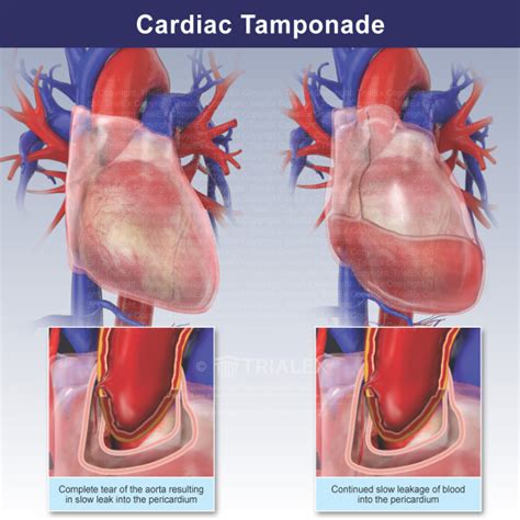 Pericardial Tamponade Trial Exhibits Inc