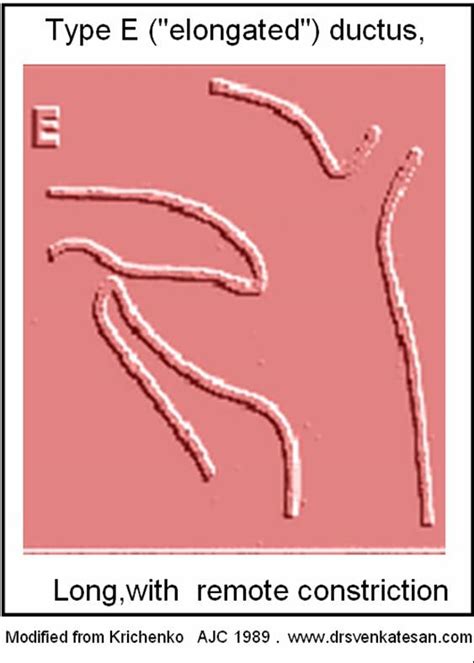 2mm Pda Dr S Venkatesan Md