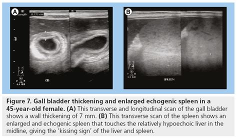 Abdominal Ultrasound Findings In Hiv And Tuberculosis