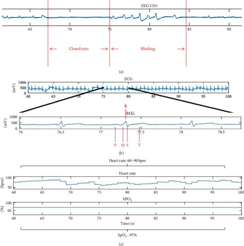Wearable Multimodal Biosignal Acquisition System For Potential Critical And Emergency