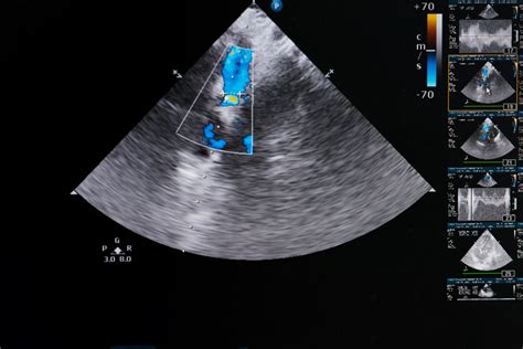 Echocardiogram Singapore Somerset Imaging Center Hsig Org