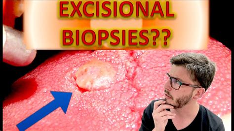 Excisional Biopsy Tutorial Step By Step Oral Medicine Dentistry For Lesions Tongue Fibroma