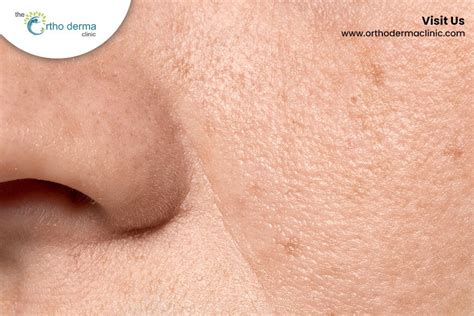 Causes And Treatments Of Open Pores
