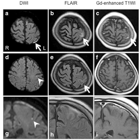 Brain Mri Scan Findings At Admission A Axial Dwi Showing Restriction Download Scientific