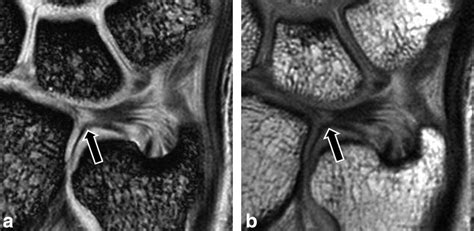 Triangular Fibrocartilage Complex Mri