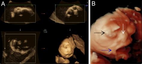 Two And Three Dimensional Sonographic Findings Of Harlequin Ichthyosis
