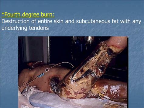 Ppt Dermatoses Resulting From Physical Factors Powerpoint