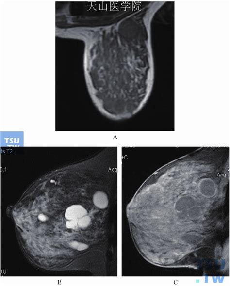 乳腺常见病变的mri表现 乳腺肿瘤学 天山医学院