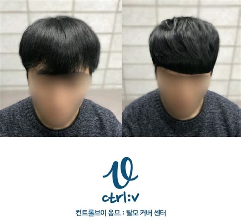 머리숱 없는 남자 머리 과거와 현재 네이버 블로그