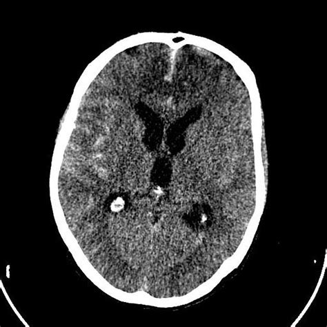 Anterior Cerebral Artery Stroke Anterior Cerebral Artery Stroke