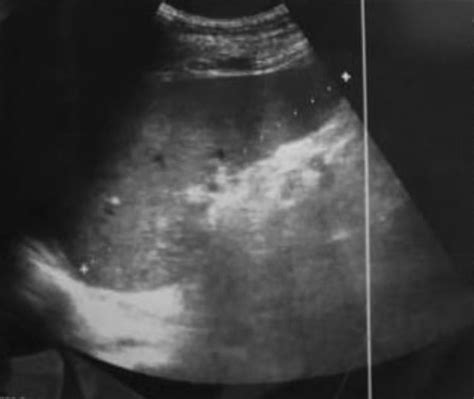 Pelvic Ultrasound Demonstrating An Enlarged Uterus With A Heterogeneous