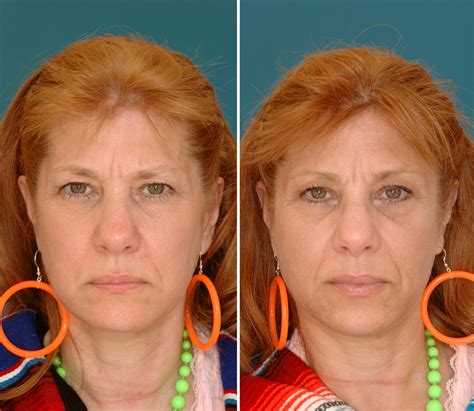 Sunscreen Vs No Sunscreen Aging Twins Why You Need Sunscreen Every