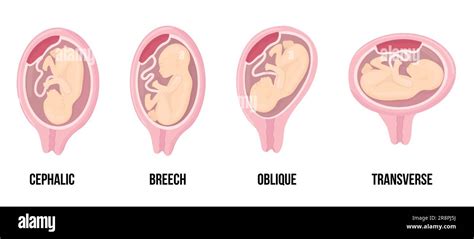 Uterus Position During Pregnancy Fetal Positions Nursing Nclex