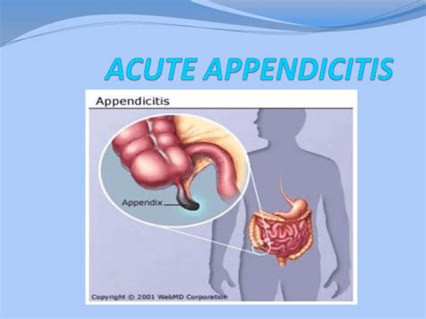 Acute Appendicitis Symptoms Diagnosis And Treatment