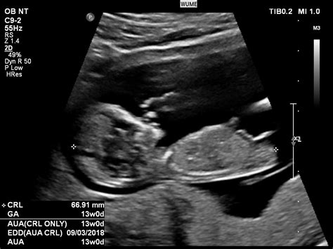 Ultrasound In Pregnancy Womens Ultrasound Melbourne