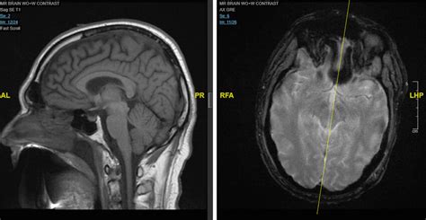 Brain Magnetic Resonance Imaging 5 Months After Initial Download Scientific Diagram