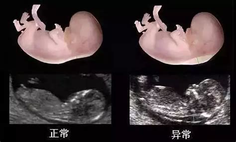 什么是NTNT增厚怎么办孕妈妈快看 新闻资讯 广州爱博恩医疗集团有限公司