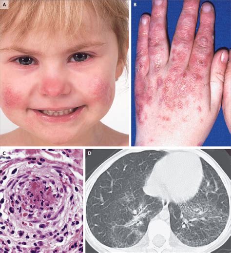 Clinical Features Of Stimulator Of Interferon Genes Sting Associated Download Scientific