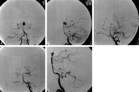 Patient 6 A 53 Year Old Woman With A Ruptured Basilar Tip Aneurysm 14 Download Scientific