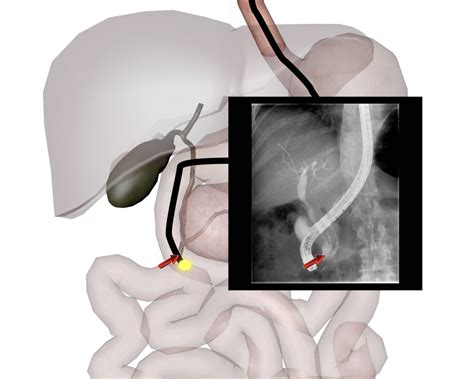 ERCP Bariatric Surgery Education