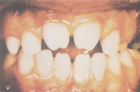 先天性梅毒 性传播疾病病征处治 医学