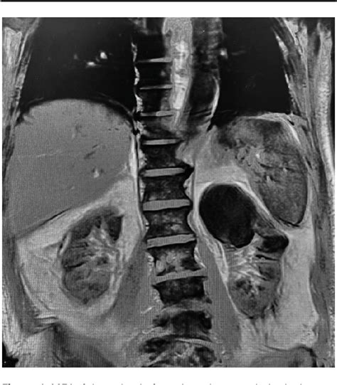 Figure 3 From A Case Of Streptococcus Mutans Endocarditis With Cardiac Surgical Indication And