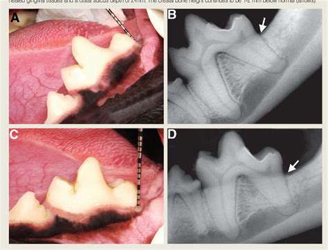 Figure 3 From Modified Distal Wedge Excision For Access And Treatment