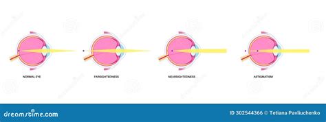 Astigmatism Disorder Medical Illustration 308476378