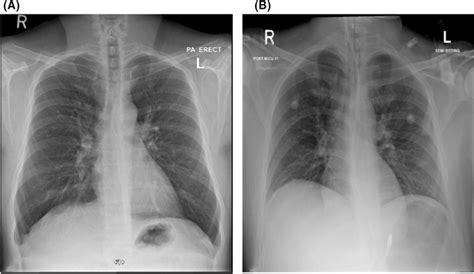 A Before Intubation And B After Intubation Download Scientific