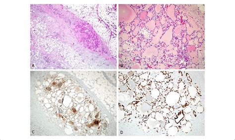 Microphotograph Of Thyroid Ectopia In The Periappendiceal Adipose
