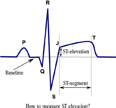 Figure 3 From Biomedical Time Series Preprocessing And Expert System