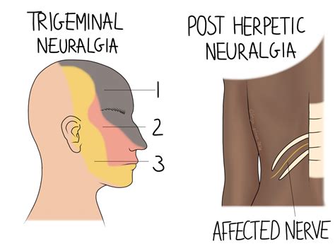 Trigeminal Neuralgia Trigger Points